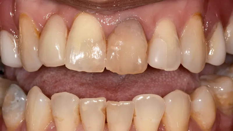 Multi-Layer Zirconia Restorations - Australian Digital Dentistry Academy